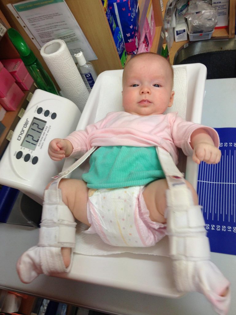 Congenital Dislocation of the hip and the Pavlik's harness – Nurture ...